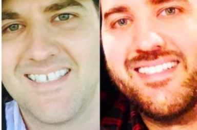 Byte Review - All Day vs At Night Aligners, Which are Best?