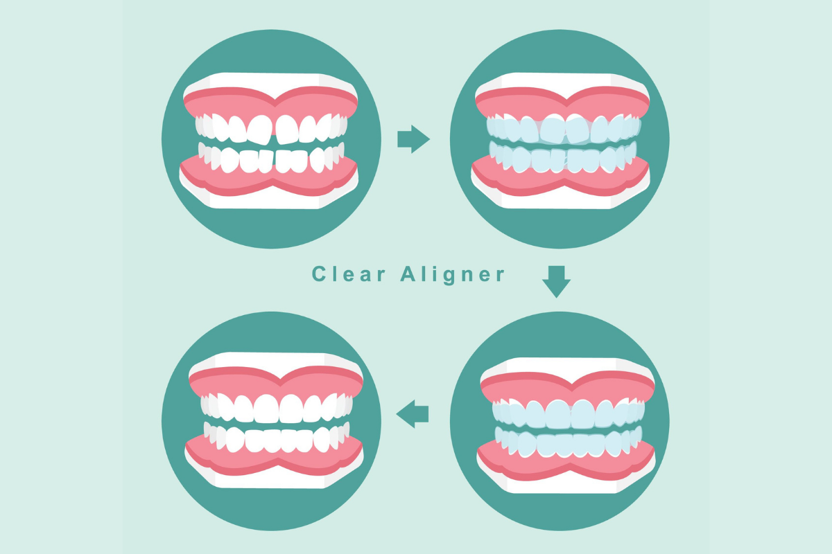 Byte Review - All Day vs At Night Aligners, Which are Best?