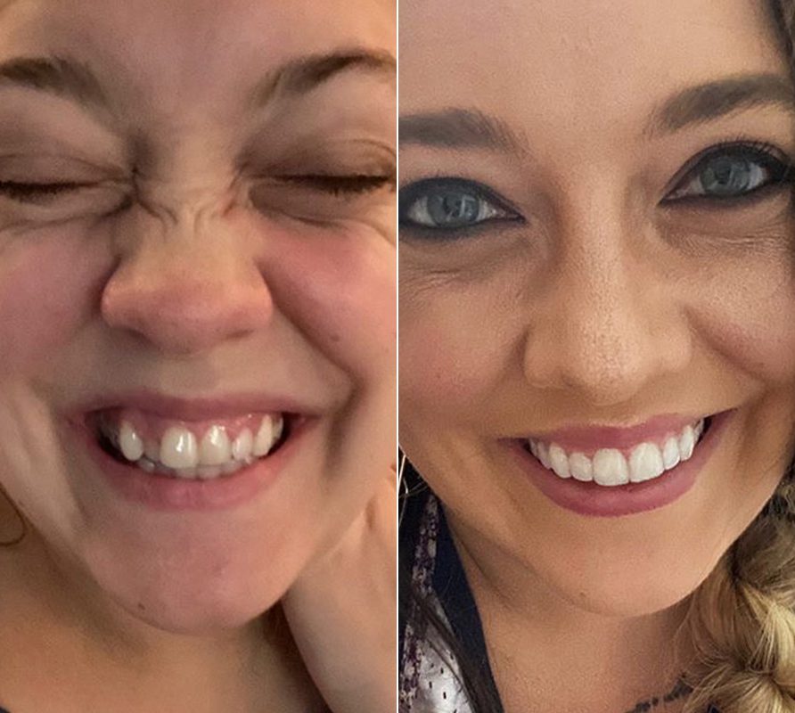 Byte vs Smile Direct Club — Which are the Best Home Aligners?